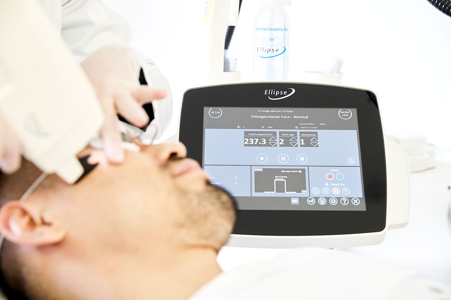 Ellipse SWT/IPL Laser Acne Clearance - The London Cosmetic Clinic