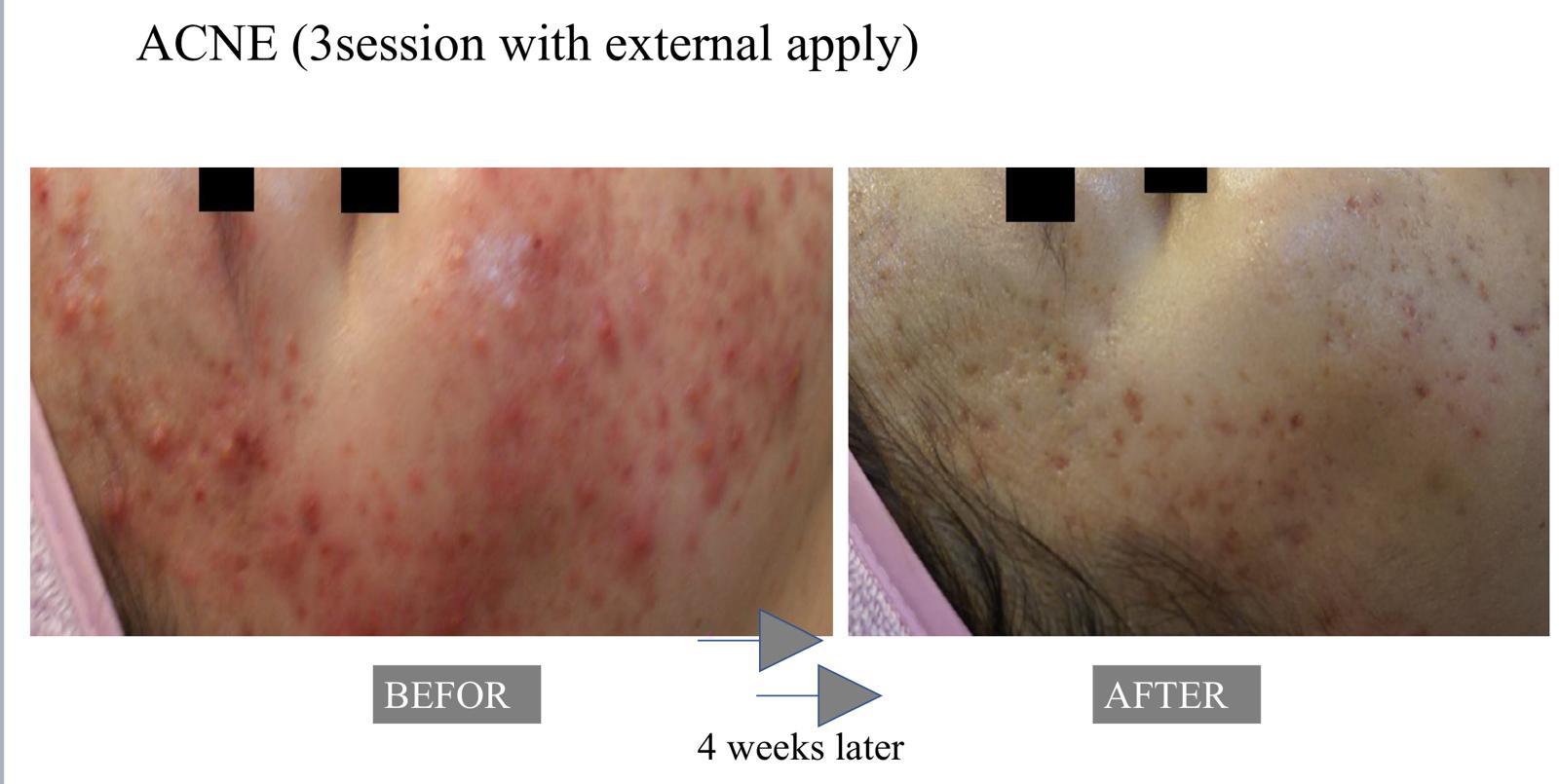 Exosome Treatment at The London Cosmetic Clinic