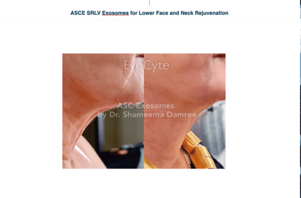 Exosome Treatment at The London Cosmetic Clinic